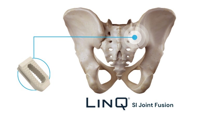 Sacroiliac Fusion Sacroiliac Joint Pain Helena | Spine Deformities